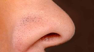 3 Jenis Makanan yang Dapat Memicu Timbulnya Komedo