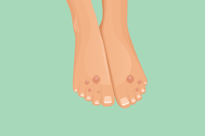 Cara Ampuh Mengobati Kutu Air di Kaki