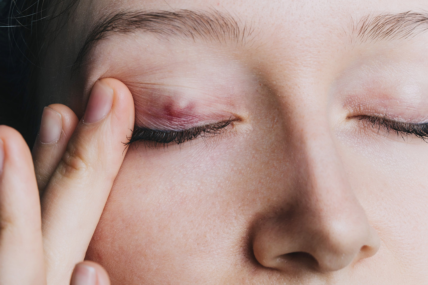 Tidak Sama Ketahui Perbedaan Bintitan Dengan Mata Merah Tidak Sama Ketahui Perbedaan Bintitan Dengan Mata Merah