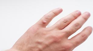 5 Cara Hilangkan Kutil di Tubuh