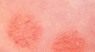 Kenali 4 Jenis Dermatitis dan Cara Mengatasinya