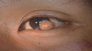 Jangan Sepelekan 7 Gejala Kista Ini